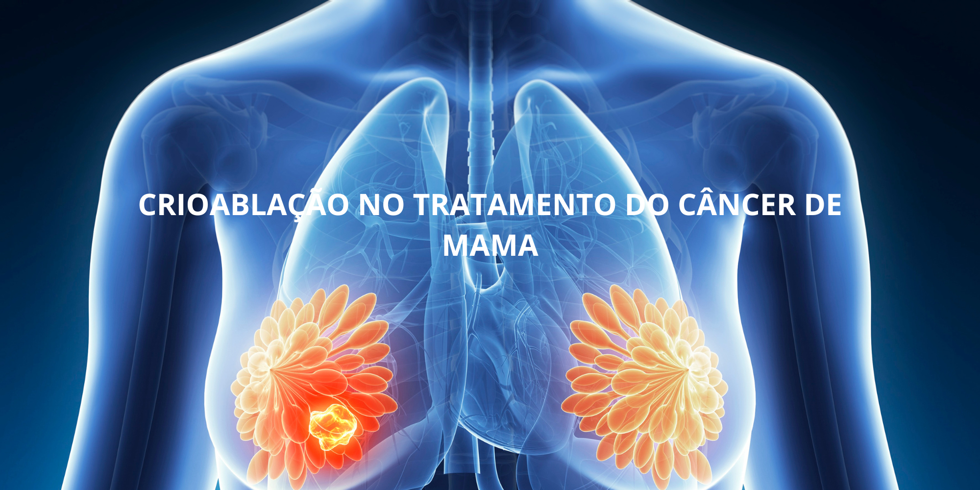 Crioablação no tratamento de câncer de mama - Clínica CIBLE